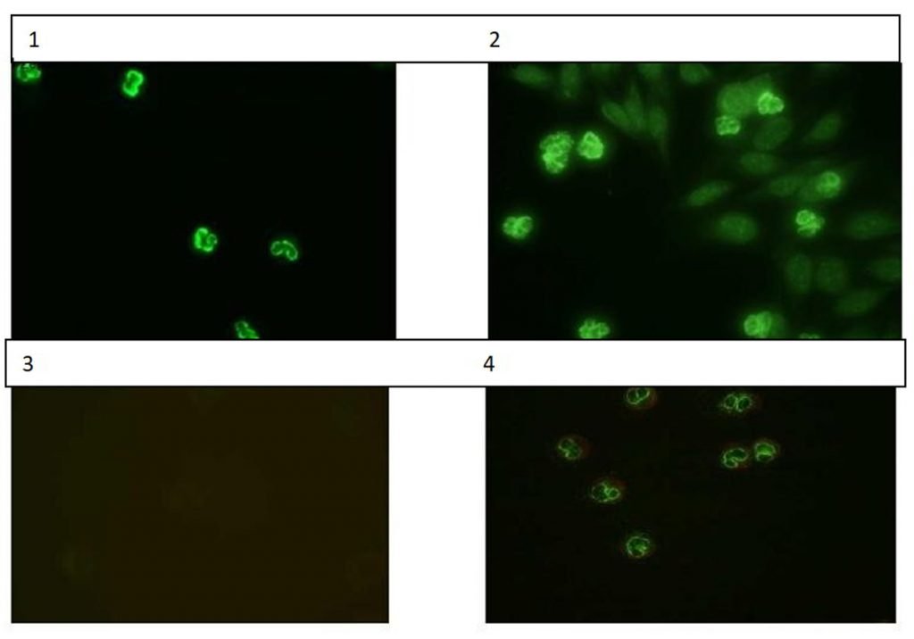 Vasculitis: anticuerpos anticitoplasma de neutrófilos (ANCA). Protocolo ...