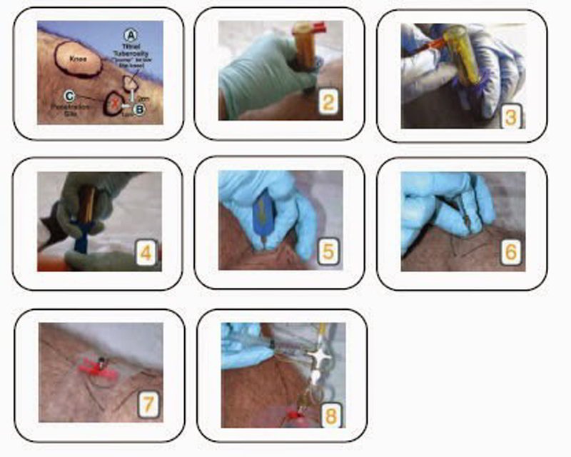 Vía intraósea - Ocronos - Editorial Científico-Técnica