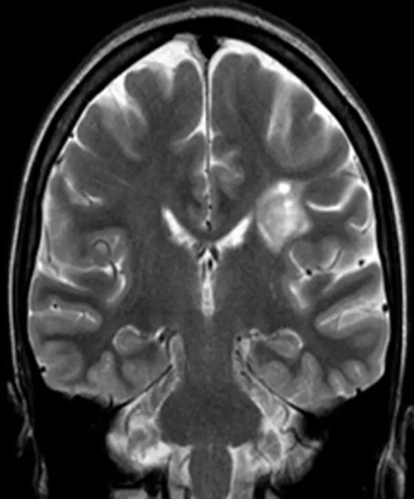 Variantes tumefactivas de la esclerosis múltiple - Ocronos - Editorial ...