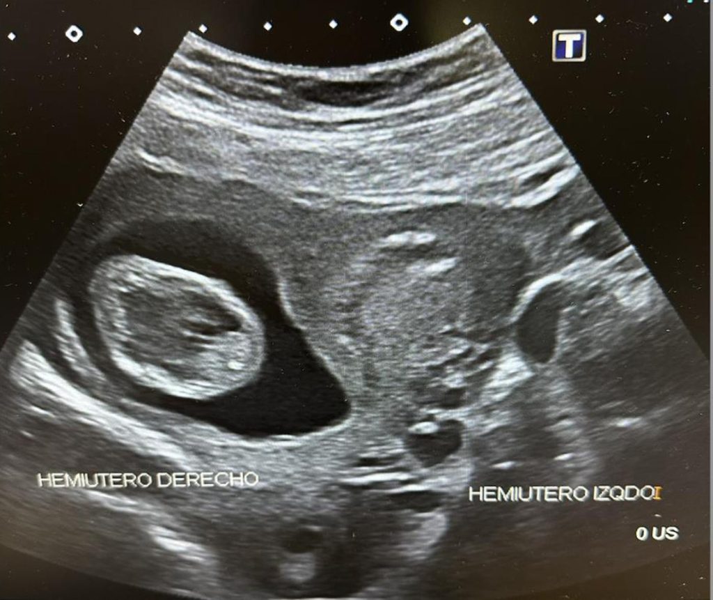 Gestación en mujer con útero septo: reporte de un caso - Ocronos ...