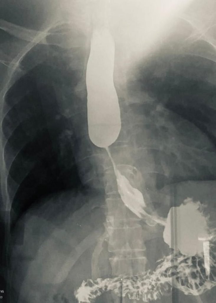 Estenosis esofágica compleja post-ligadura con bandas elásticas y ...