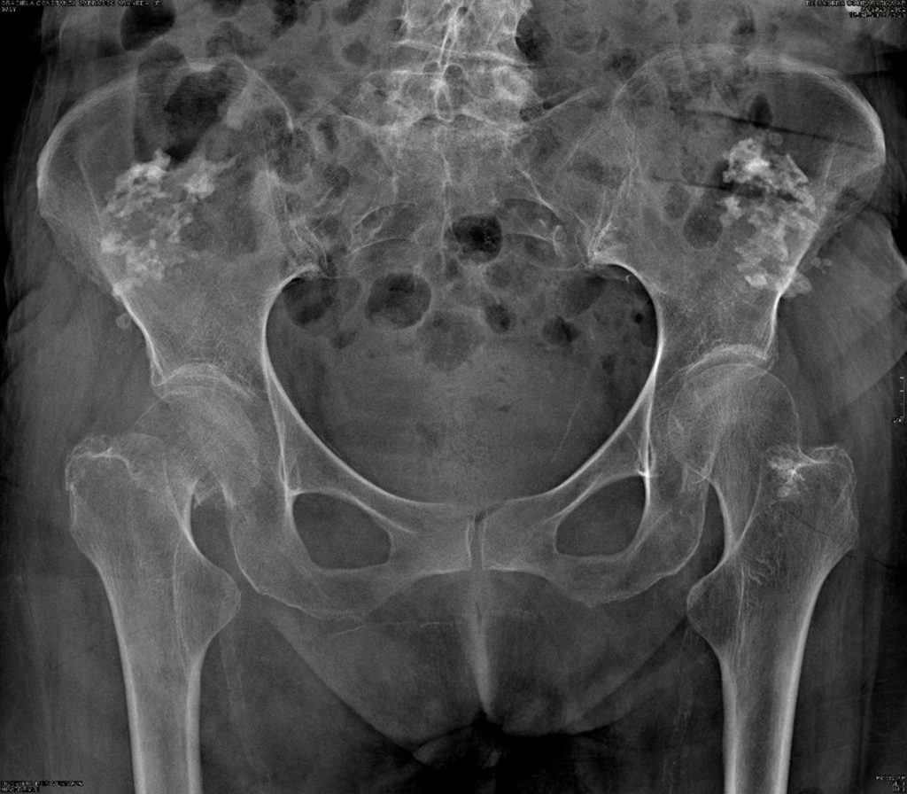 Fractura de cadera subcapital con signos de impactación y ...